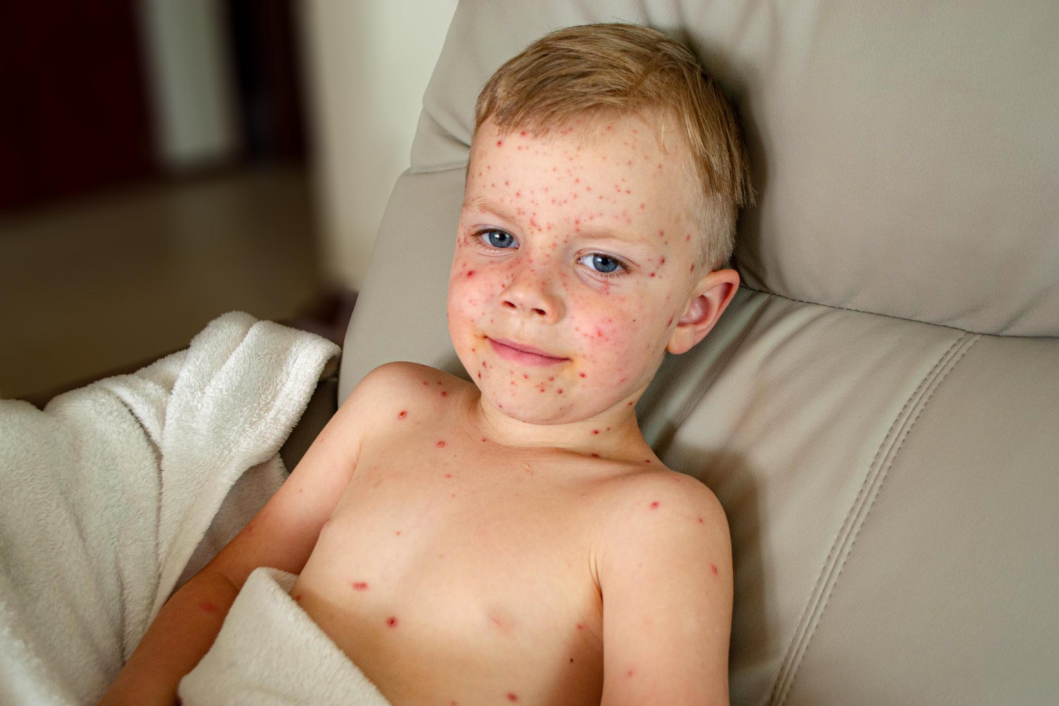 Recognizing Chicken Pox Symptoms: Early Signs and What They Mean ...
